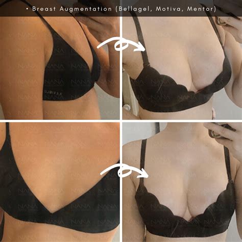 Breast Augmentation Artofit