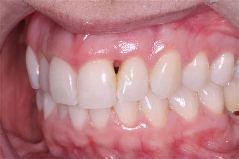 Fixing Gap Between Teeth Oral Plastic Surgery