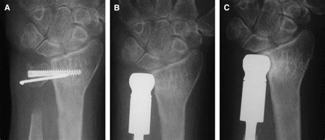 Use Of An Ulnar Head Endoprosthesis For Treatment Of An Unstable Distal