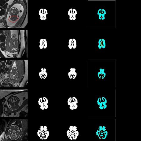Examples Of Segmentation Results For Bottom Slices Note That Each