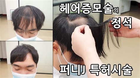 정품 퍼니j 헤어증모술은 탈모인의 헤어스타일까지 생각합니다 Youtube