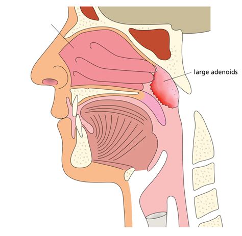 Adults And Adenoids At Alfred Ma Blog