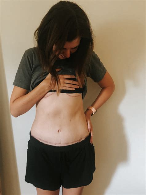 Pin On Mastectomy
