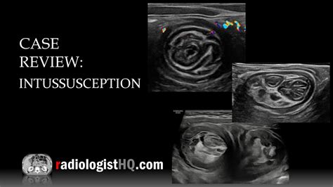 Ultrasound Of Intussusception Youtube