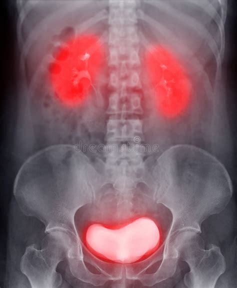 Intravenous Pyelogram Or I V P Stock Image Image Of Nephrology Intra 281853307
