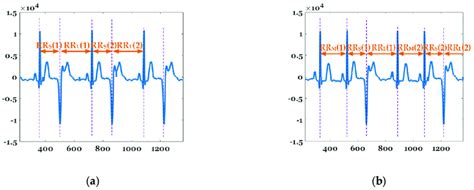 Features Of A Bigeminy And B Trigeminy Download Scientific Diagram Features Of A Bigeminy And B Trigeminy Download Scientific Diagram
