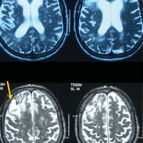 Pdf Mirrored Self Misidentification In A Patient Without Dementia