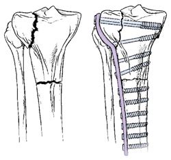 Proximal Tibia Fracture FV Magazine