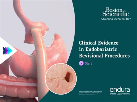 Transoral Outlet Reduction Tore Boston Scientific
