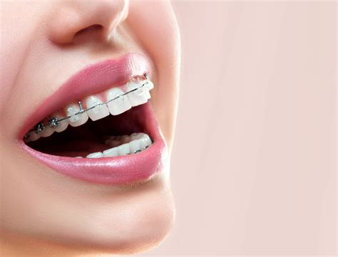 Brackets Damon Vs Tradicionales Ortodoncia Ourense