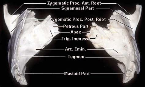 Superior View Of The Left And Right Temporal Bones Neuroanatomy The