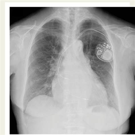 Posteroanterior View Of The Chest Radiograph After Pacemaker Implantation Download Scientific