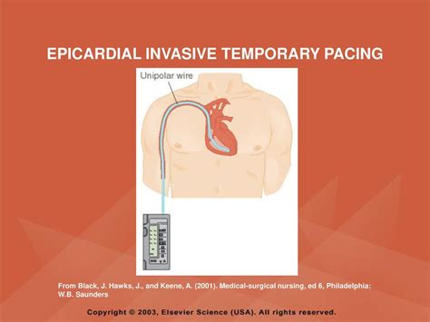 Cardiac Dysrhythmias Ppt Download