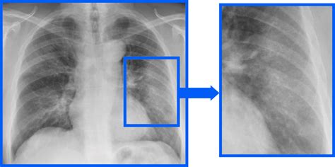 Sars Cov 2 Pneumonia Diffuse Interstitial Thickening With Faint Download Scientific Diagram