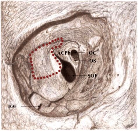 Artistic Illustration Of A Right Orbit Showing The Mini Craniotomy Download Scientific Diagram