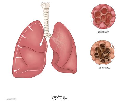 肺气肿 医学插画