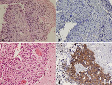 Brain Metastasis From Non Small Cell Lung Cancer Use Of Epidermal