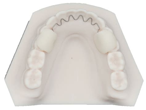 V Loop Bonded Retainer Protec Dental