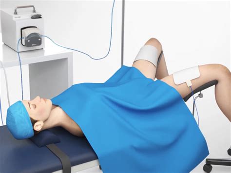 Uterine Fibroids Gentle Thermoablative Treatment With Rfa
