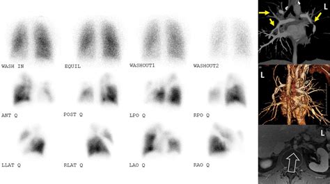 Perfusion Scintigraphy In Diagnosis And Management Of Thromboembolic Pulmonary Hypertension