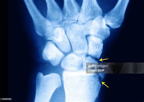 Fracture Of The Scaphoid And The Radius X Ray Of A Left Hand Dorsal