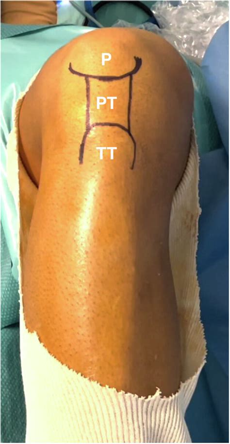 Patient Positioning And Landmarks Right Knee Frontal View Positioned