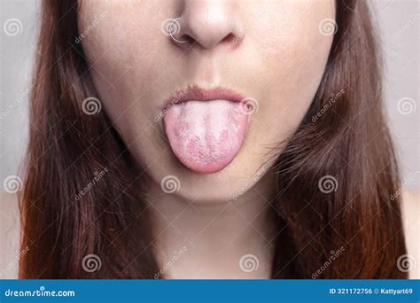 Woman Shows A White Tongue A Common Symptom Of A Candida Albicans