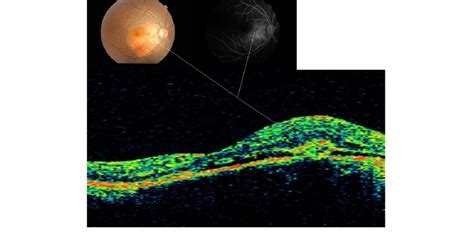 Ffa And Oct Showing Corresponding Location Of Cnvm Associated With