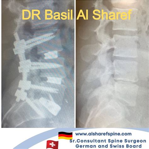 Spinal Lumbar Fusion Surgery L3 S1 Best Spine Surgeon Dubai Best