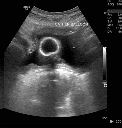 Foley Catheter Ultrasound Dover Foley Catheter Jufvg