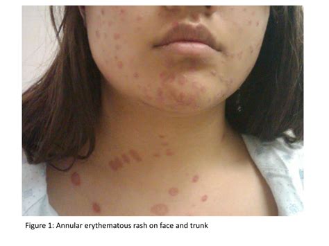 Ppt Figure 1 Annular Erythematous Rash On Face And Trunk Powerpoint