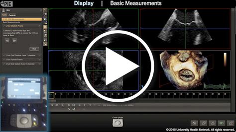 Virtual Tee Technology Transesophageal Echocardiography 3d Heart