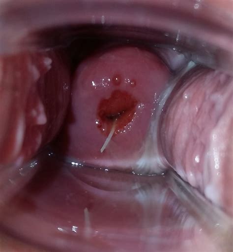 Mirena Iud In Cervix