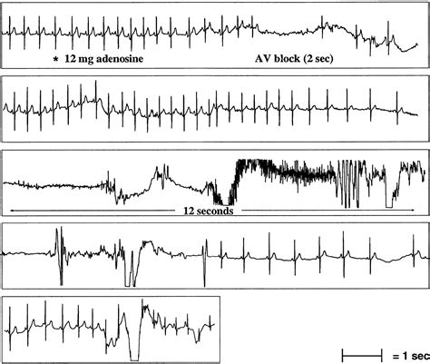 Induction Of Neurally Mediated Syncope With Adenosine Circulation