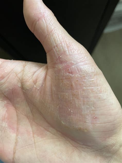 Dyshidrotic Eczema R Dyshidrosis