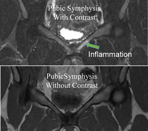 Clinmed International Library Osteitis Pubis In A 30 Year Old