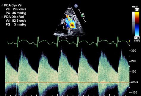 Diagnosis Management Of Patent Ductus Arteriosus Rrn