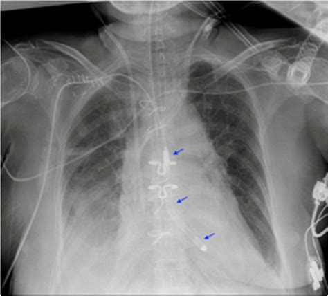 Impella In The Correct Position Device Is Placed Into The Left