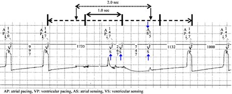 Ecg Of The Pacemaker Which Observed Oversensing In Ecg One Pacemaker Download Scientific