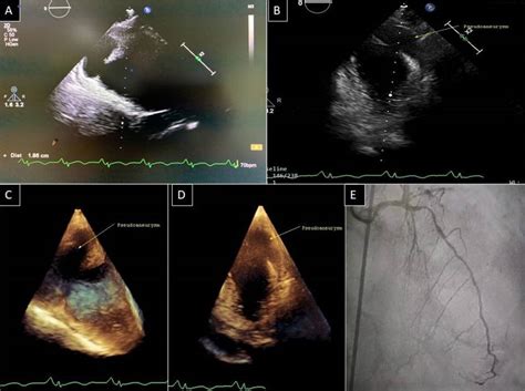 Pseudoaneurysm