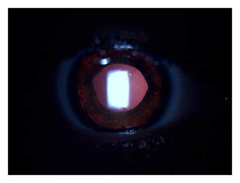 A Transillumination Defect Is Remarkable On The Biomicroscopic Examination Download