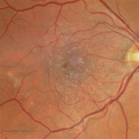 Retinography Sharing And Learning On Linkedin Erm Ectopic Inner