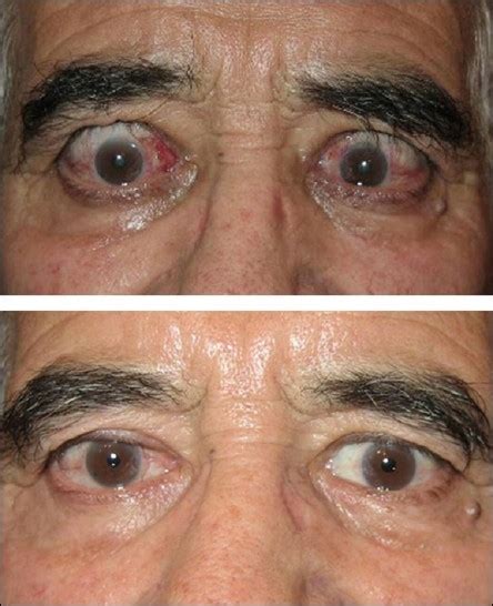 Maladie De Graves Basedow Npem