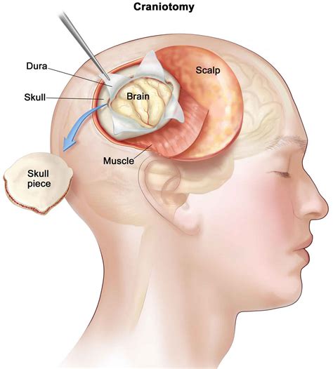 Pituitary Adenoma Causes Symptoms Diagnosis Treatment And Prognosis