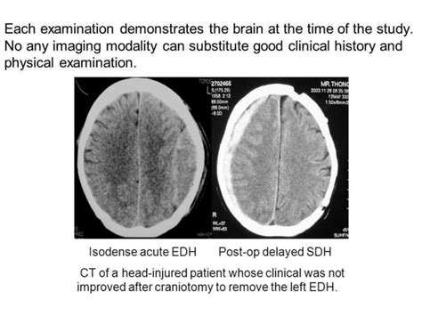 Epidural Haematoma Extradural Haemorrhage Pptx