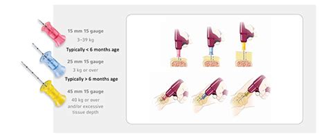 Tibia Proximal Io Arrow® Ez Io® Talon™ Needle Set