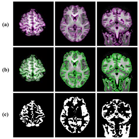 mri cerebral tissue segmentation based on fuzzy level set for gray download scientific diagram