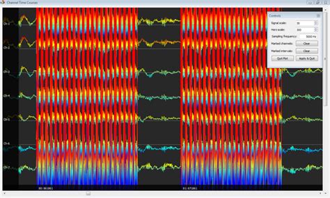 Simultaneous Eeg Fmri Fmri Artifact Detection And Removal