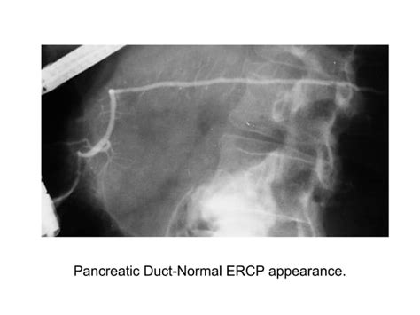 Endoscopic Retrograde Cholangiopancreatography Pptx