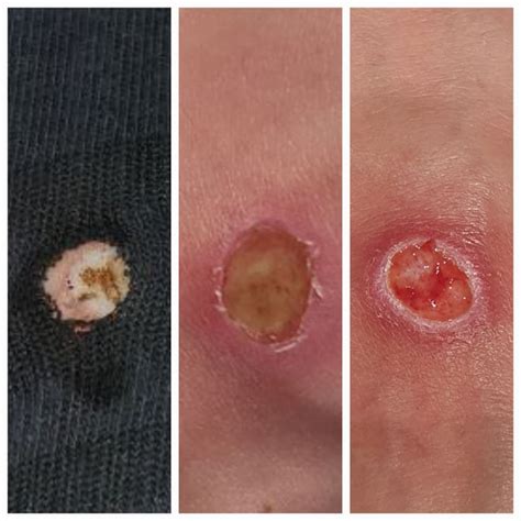 Is My Second Degree Burn Healing Currectly Ive Posted An Explanation